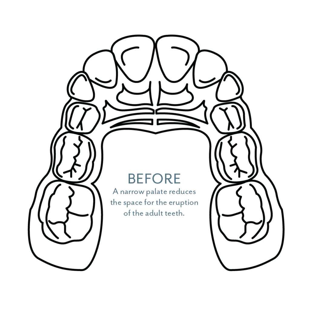 What Is An Expander? | Kelley Orthodontics | Mt. Pleasant Orthodontist