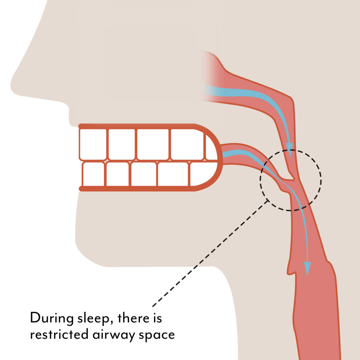 Overbite, Underbite, Crowding? | About Your Smile | Kelley Orthodontics